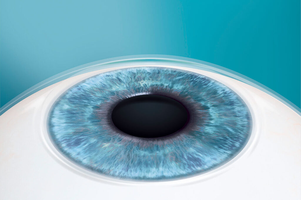 EVO ICL in Bend, OR | OnSight Eye Center